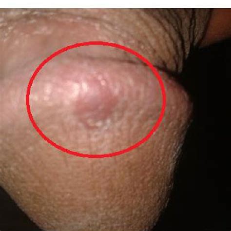 Aphthosis Of Glans Penis Was Detected In The Examination Download