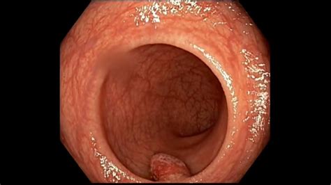 Colonoscopic Polypectomy Bd Endoscopy Youtube