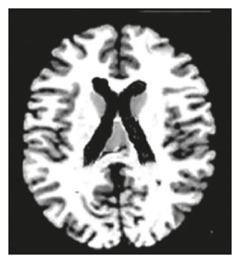 The Brain Tissue Mri Image Segmentation Results Based On The Flicm Download Scientific Diagram