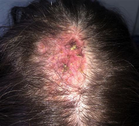 Erosive Pustular Dermatosis Of The Scalp And Multiple Sclerosis Just A