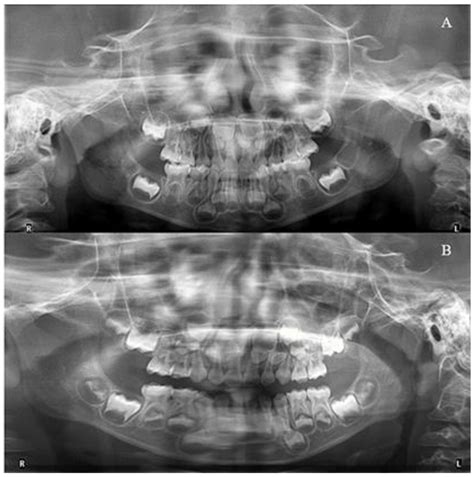 The Initial And Final Radiographs A Pre Treatment B Post