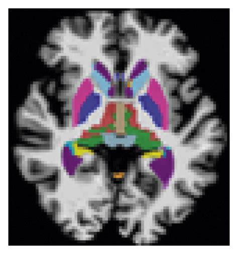 Subcortical Brain Segmentation Download Scientific Diagram