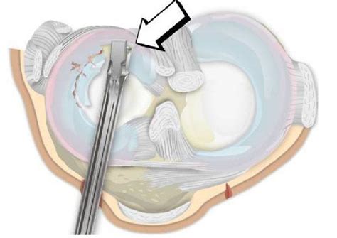 Knee Arthroscopy Marcheggiani Muccioli