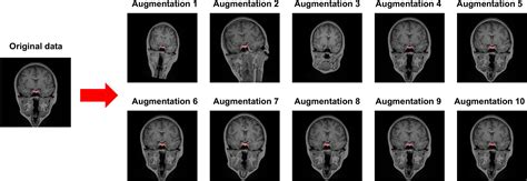 Normal Pituitary Mri T2