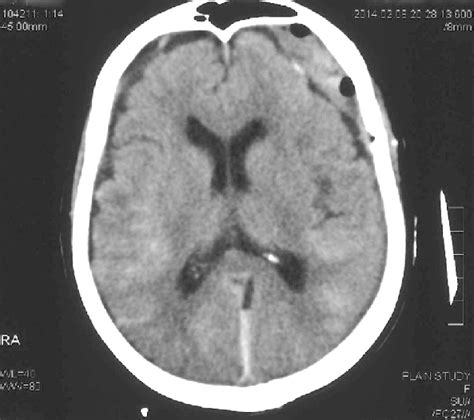 Postoperative Computed Tomography Scan Of The Brain Showing Diffuse Download Scientific Diagram
