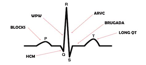Syncope Simplified Emergency Medicine Cases