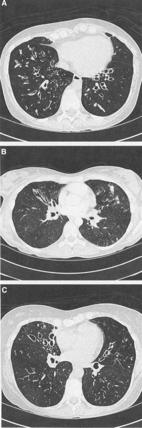 Bronchiectasis Chest