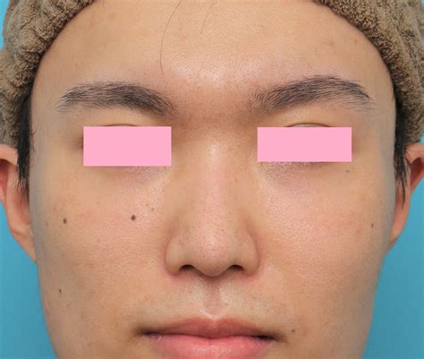 先日アップした、小鼻縮小手術を行った20代男性症例写真の解説です。 美容整形高須クリニック 高須 幹弥 オフィシャルブログ