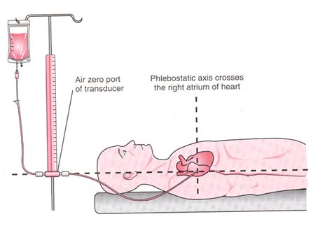 Hemodynamics