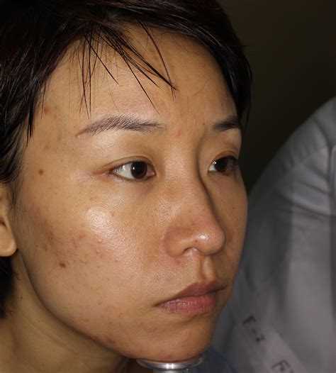 Yolo5 Acne Detection Object Detection Dataset By Acne Severity