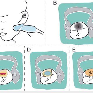 Schematic Representation Of A Ultrasound Guided Trigeminal Nerve Download Scientific Diagram