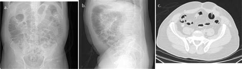 Colostomy On Ct And Fluoroscopy What The Radiologist Needs To Know