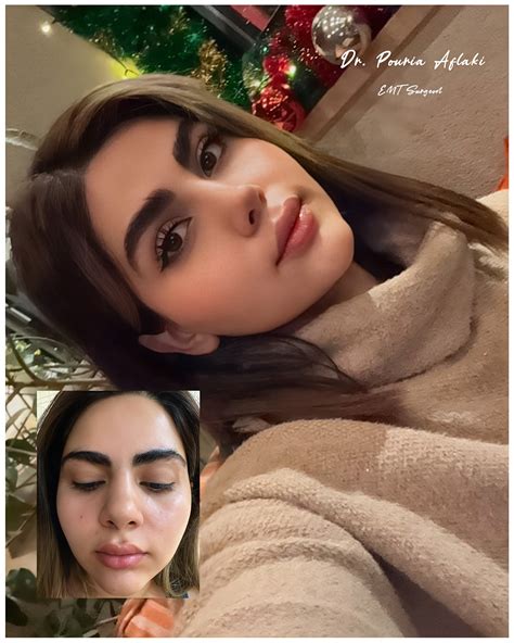 ‎جراحی بینی دکتر پوریا افلاکی‎ ‎جراحی ترمیمی بینی سه ماه بعد از عمل