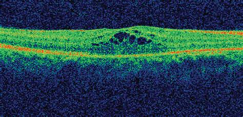 Al Serial Oct Scans Showing The Evolution Of Maculopathy Obtained
