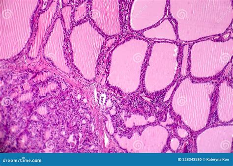Toxic Diffuse Goiter Or Graves Disease Light Micrograph Stock Photo Image Of Colloid