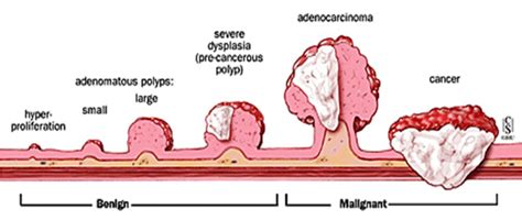 Cervical Polyp Types