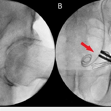 Preoperative And Intraoperative Retrograde Pyelogram A Ureter Red