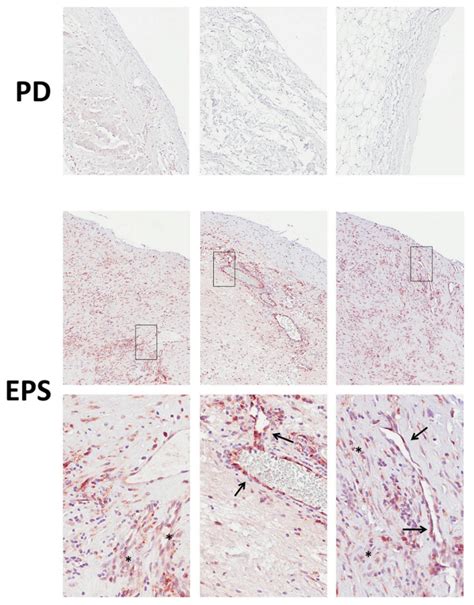 Peritoneal Ccn2 Protein Expression In Encapsulating Peritoneal