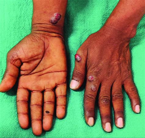 Multiple Erythematous Nodules With Hemorrhagic Crusts At Presentation