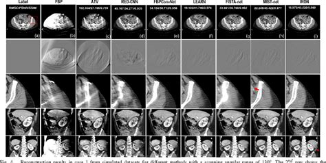 Figure 4 From Iterative Residual Optimization Network For Limited Angle Tomographic