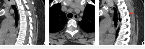 Preoperative Thoracic Spine Ct A Sagittal Ct Thoracic Spine Without Download Scientific