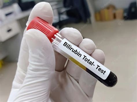 What Could Cause High Bilirubin 13 Possible Triggers List Optinghealth