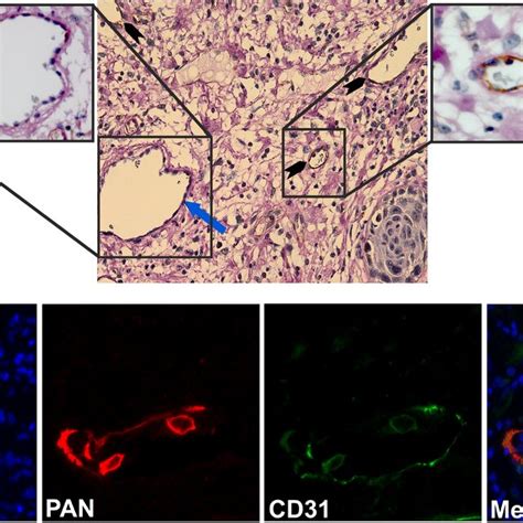 Identification Of Vasculogenic Mimicry Vm Structures In Oral Cancer