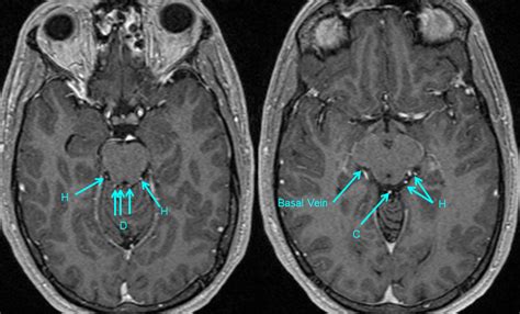 Precentral Cerebellar Vein
