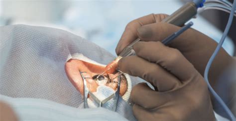 Electrosurgical Instruments Cable Assemblies Laser Welds Laser