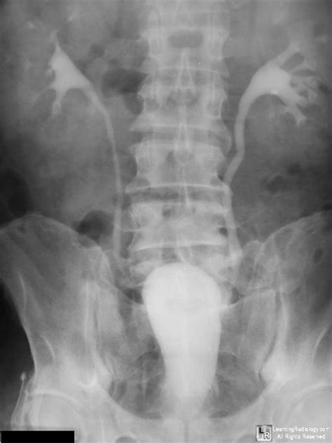 LearningRadiology Pelvic Lipomatosis Lipomatosus