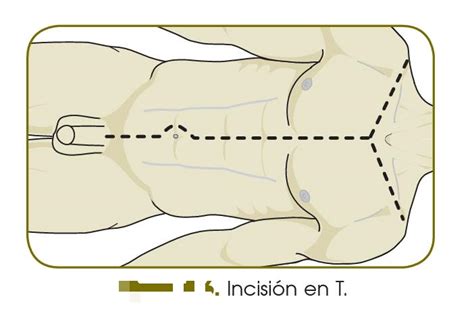 Tipos De Incisiones En La Autopsia Por Eduardo Velazquez Ayala