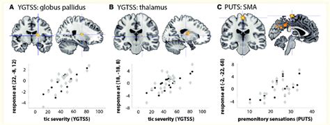 regions showing a correlation between tic severity ygtss and