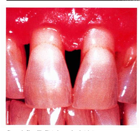 Figure 6 From A Classification System For Loss Of Papillary Height Semantic Scholar