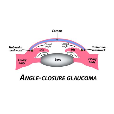 Angle Closure Glaucoma Fort Lauderdale Eye Institute