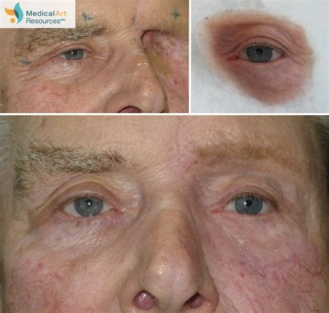 Types Of Eye Prosthesis At Paul Bullock Blog
