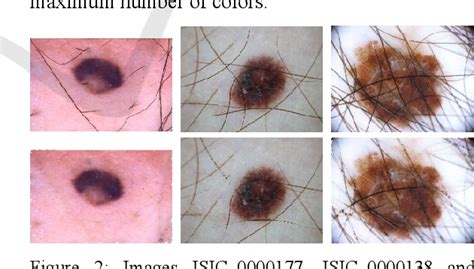 Figure 1 From Automatic Skin Lesion Segmentation Based On Saliency And Color Semantic Scholar