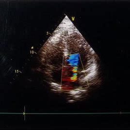 Color Doppler Echocardiography Parasternal Long Axis View Showing Download Scientific Diagram