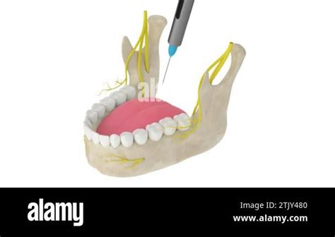 Mandibular Arch With Incisive Nerve Block Types Of Dental Anesthesia Concept Stock Video