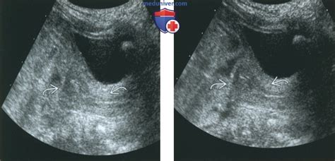 Лучевые признаки неопределенного пола