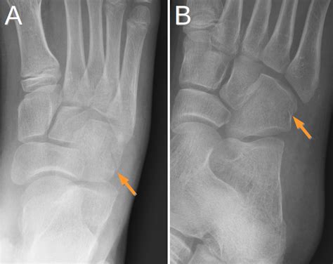 Type 3 Cuboid Fracture