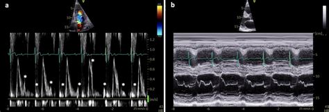transmitral pw doppler flow pattern in a patient with complete av block
