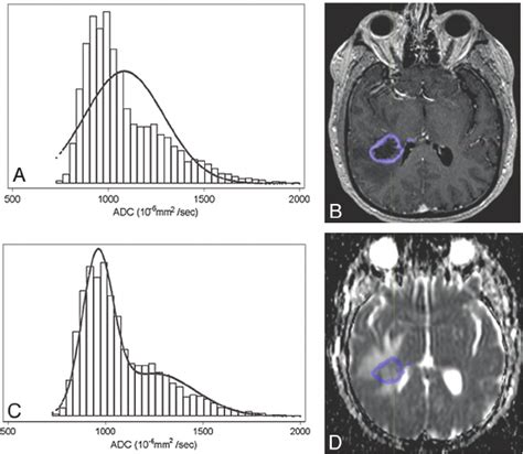 Adc Histogram And Curve Fitting Generated From Enhancing Tumor Volume