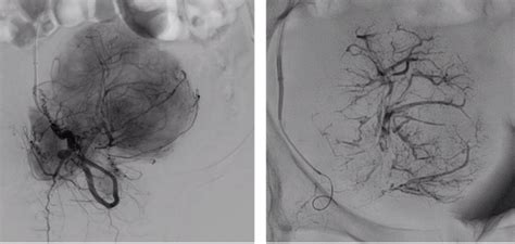 New Liquid Embolic Multicentre Trial Successfully Enrols Final Patient