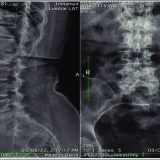 AP And Lateral Radiograph Showing L Vertebra Fracture With Vacuum Download Scientific Diagram
