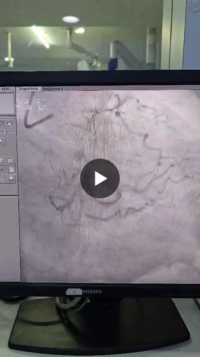 Part 2 Pci To Lad Lcx Of Same Patient Done On Next Sitting With Good Result And Patient Has