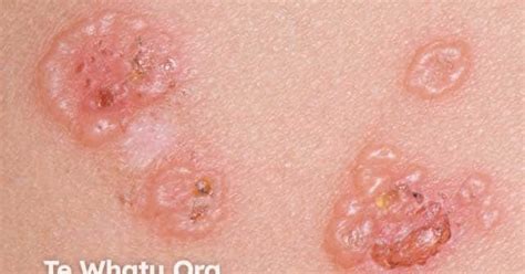 Linear Iga Bullous Disease Image