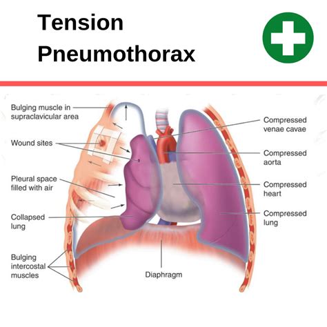 What Causes A Pneumothorax Pneumothorax Classification And Causes