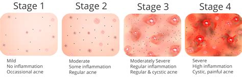 Mild Cystic Acne Diagram