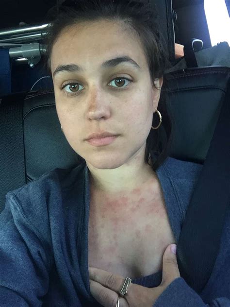 How To Get Rid Of Folliculitis According To A Dermatologist