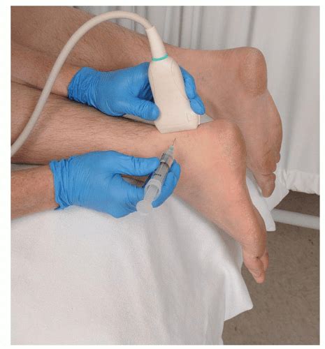 Ultrasound Guided Injection Technique For Retrocalcaneal Bursitis Pain